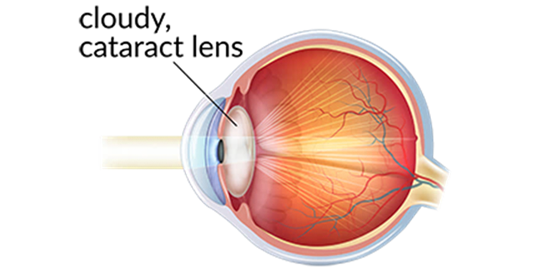 Conditions / Treatments – Eye Surgery Consultants